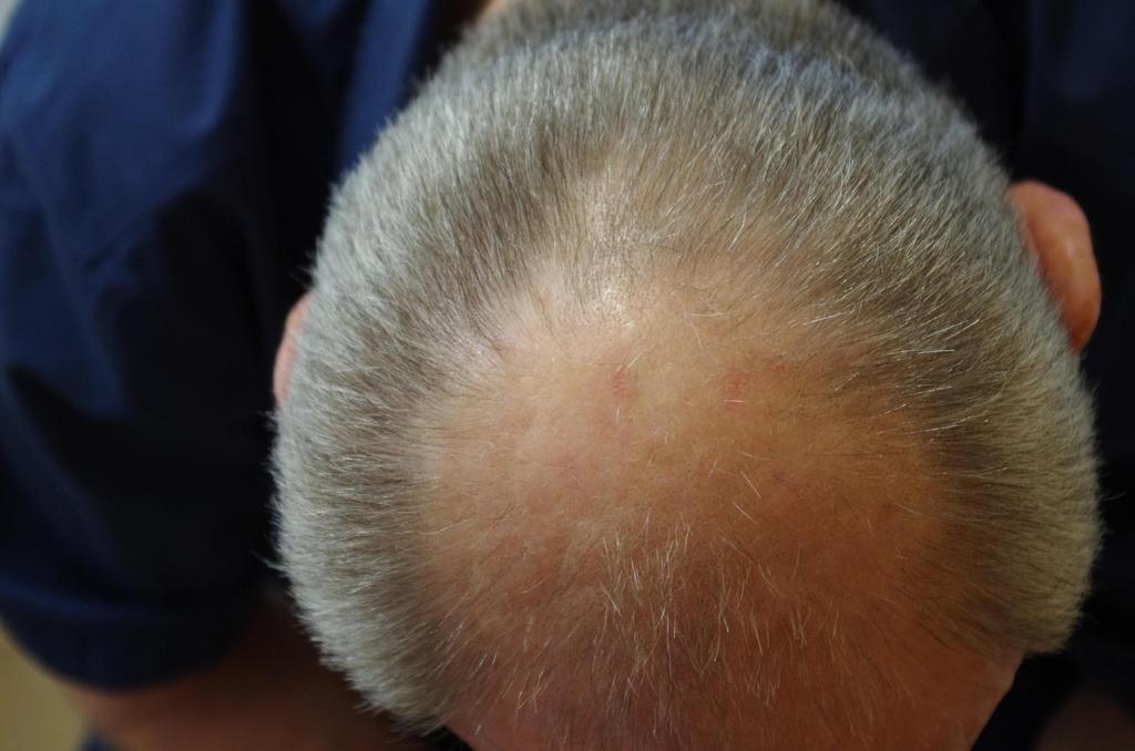 Patient observations whilst using 5-FU (Efudex) • Victoria Skin Cancer ...