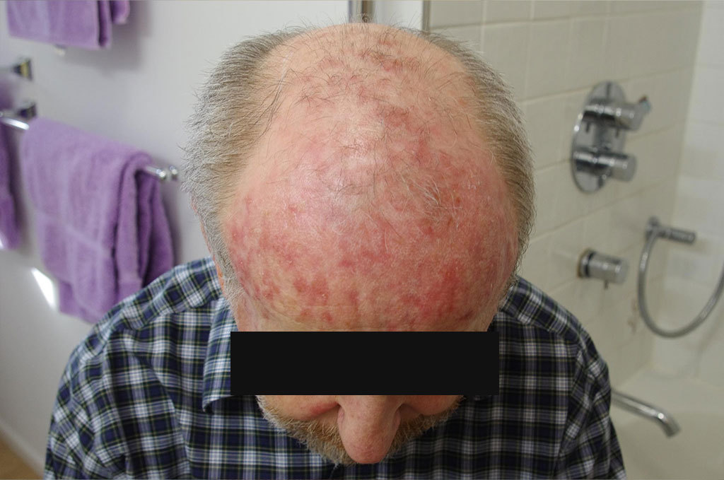 Patient observations whilst using 5-FU (Efudex) • Victoria Skin Cancer ...