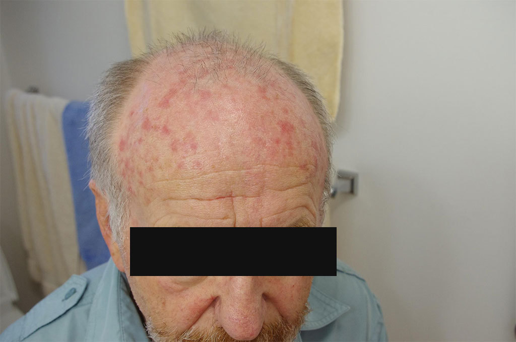 Patient observations whilst using 5-FU (Efudex) • Victoria Skin Cancer ...
